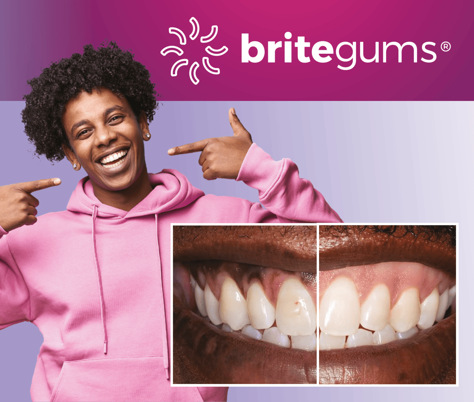 BriteGums® for a Healthier Gumline | Simpsonville, SC